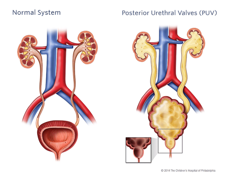 posterior-urethral-valves-illustration - Children's Surgery